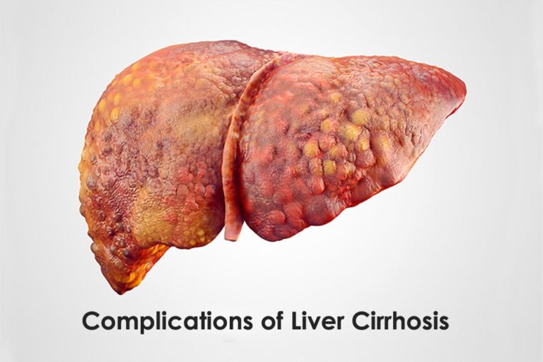 Complications of Liver Cirrhosis - Dr Pathik Parikh